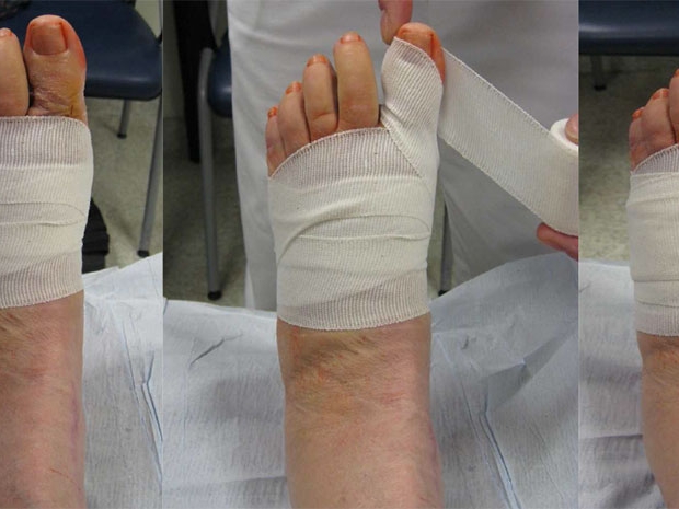 Behandlung von Hallex valgus - Ballenfuß - Chirurgische Praxis